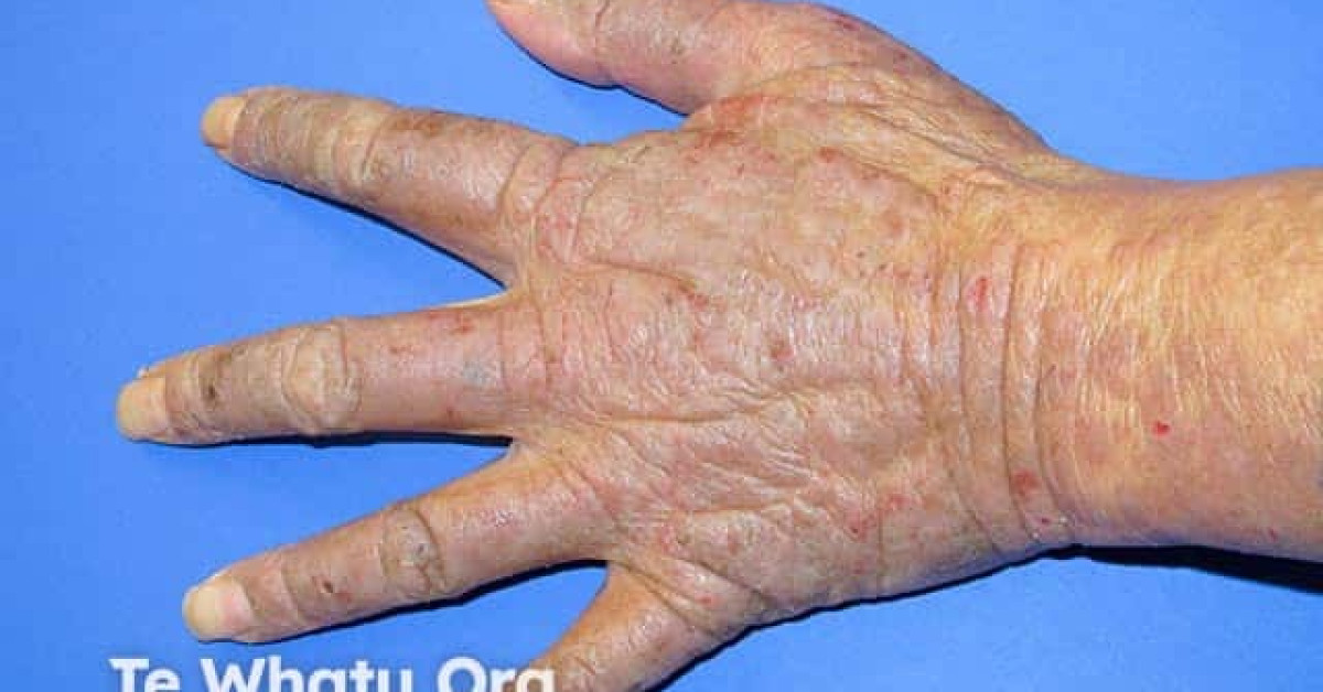 Chronic actinic dermatitis image