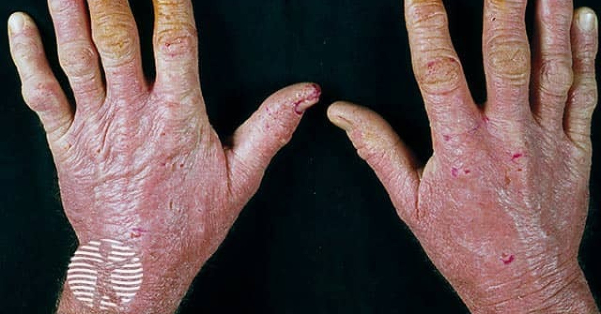 Chronic actinic dermatitis image