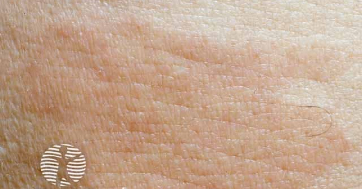 Chronic superficial scaly dermatitis image