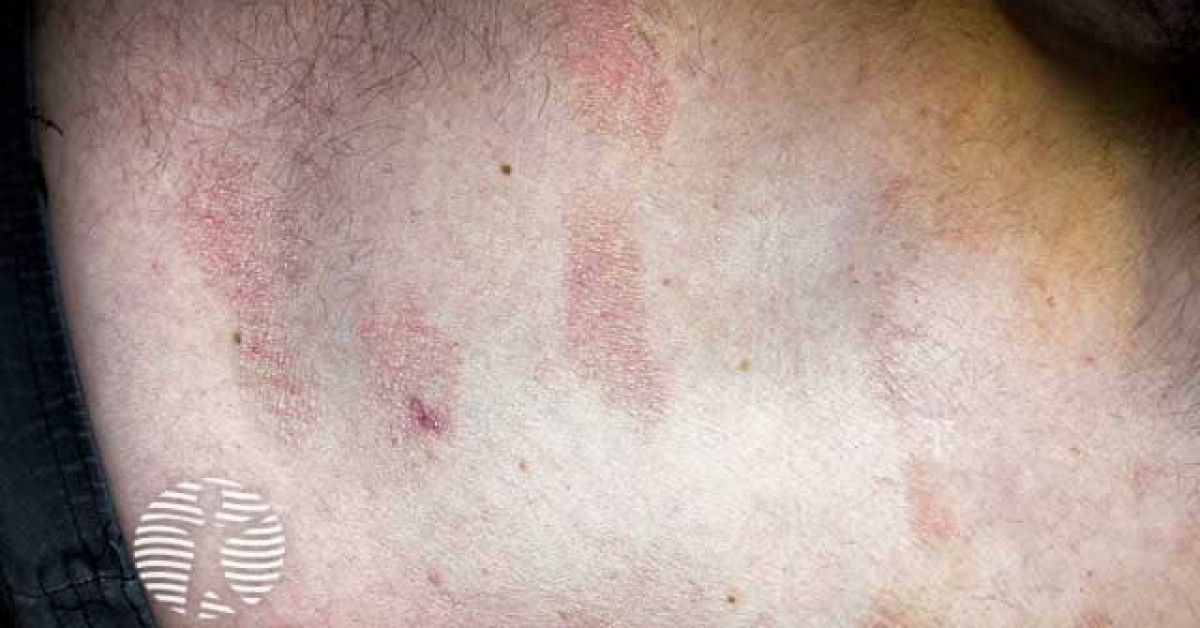 Chronic superficial scaly dermatitis image