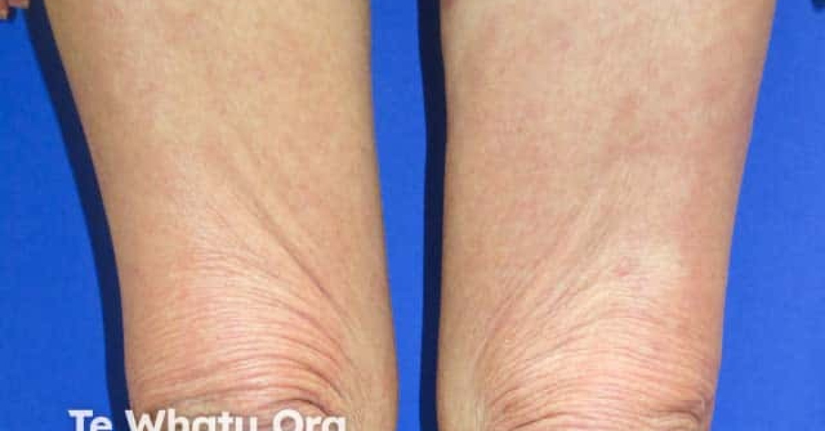 Chronic superficial scaly dermatitis image