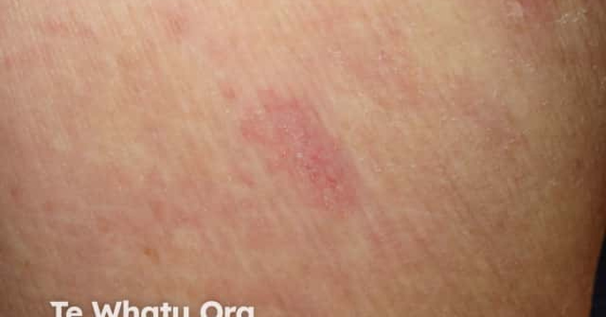 Chronic superficial scaly dermatitis image