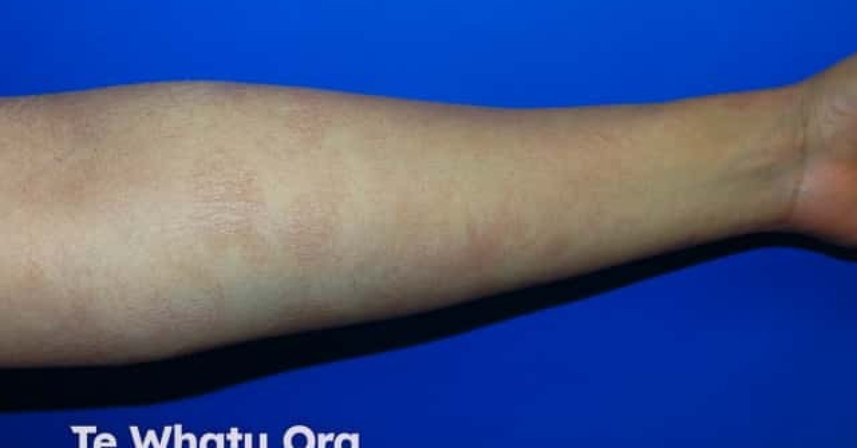 Chronic superficial scaly dermatitis image