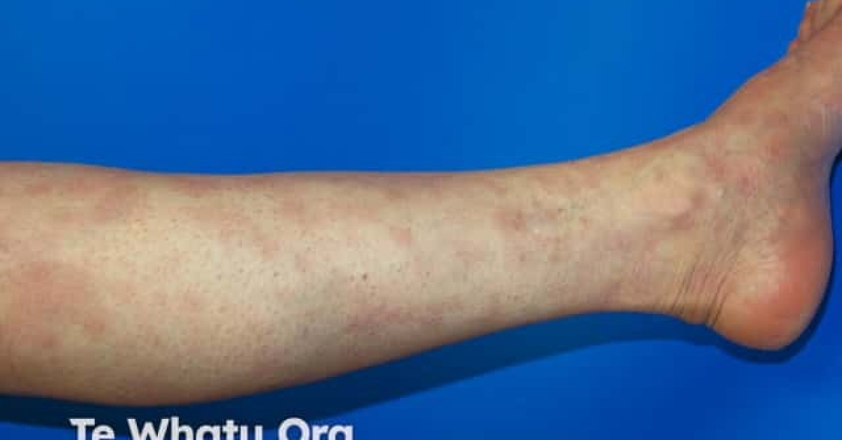 Chronic superficial scaly dermatitis image