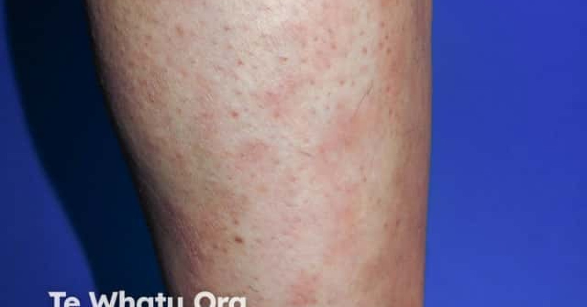 Chronic superficial scaly dermatitis image