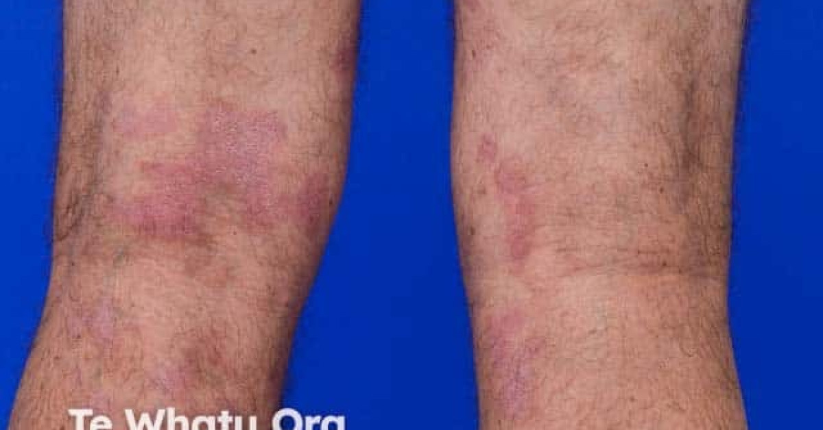 Chronic superficial scaly dermatitis image