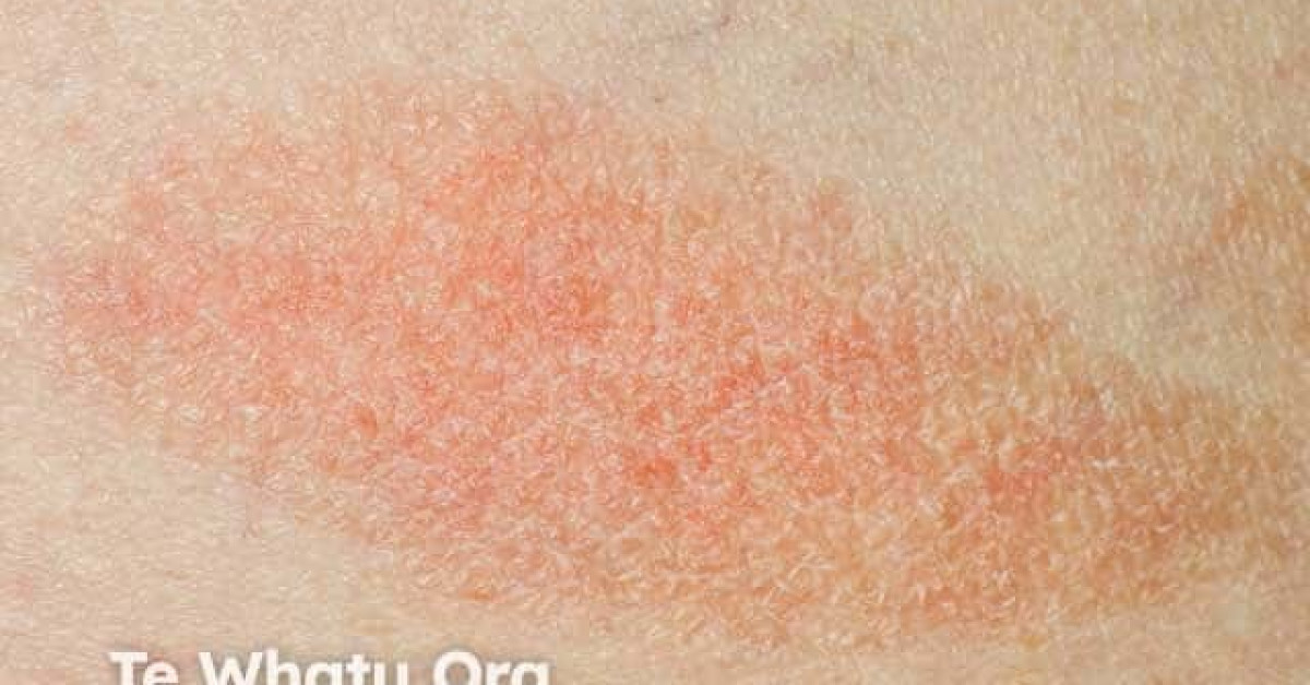Chronic superficial scaly dermatitis image
