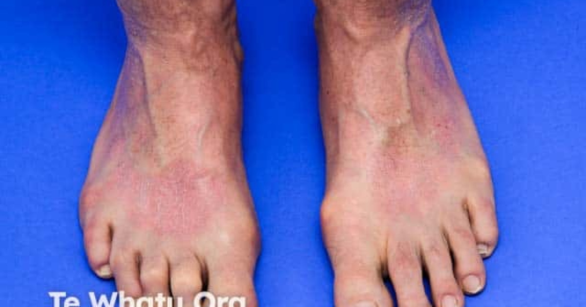 Chronic superficial scaly dermatitis image
