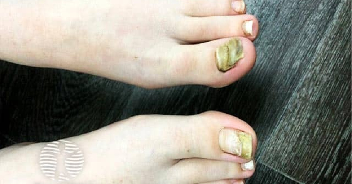 Congenital malalignment of the great toenail image
