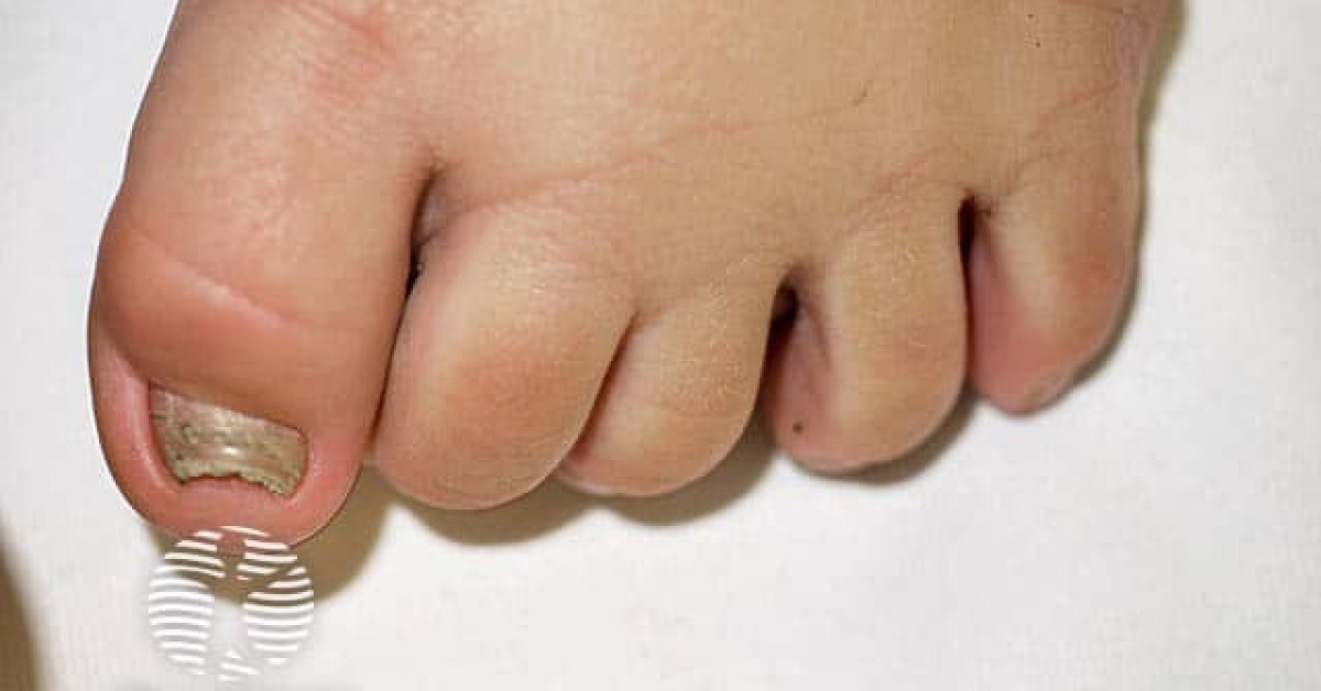 Congenital malalignment of the great toenail image