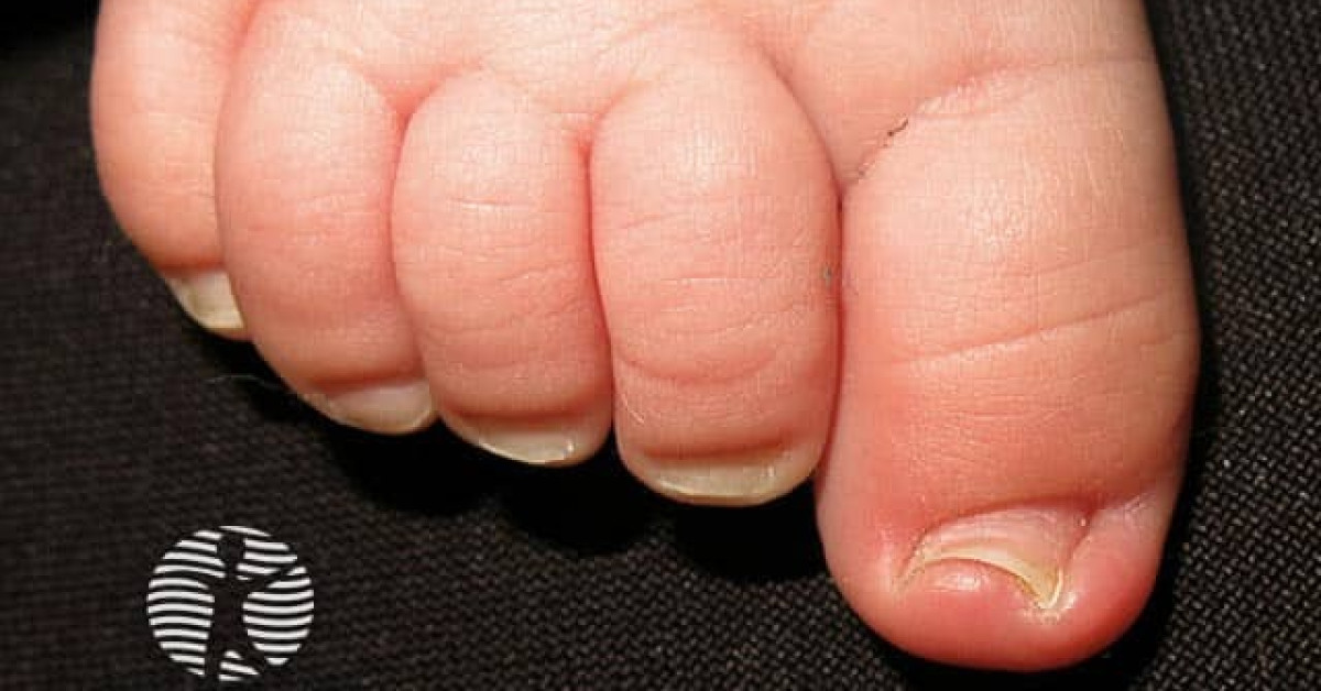 Congenital malalignment of the great toenail image