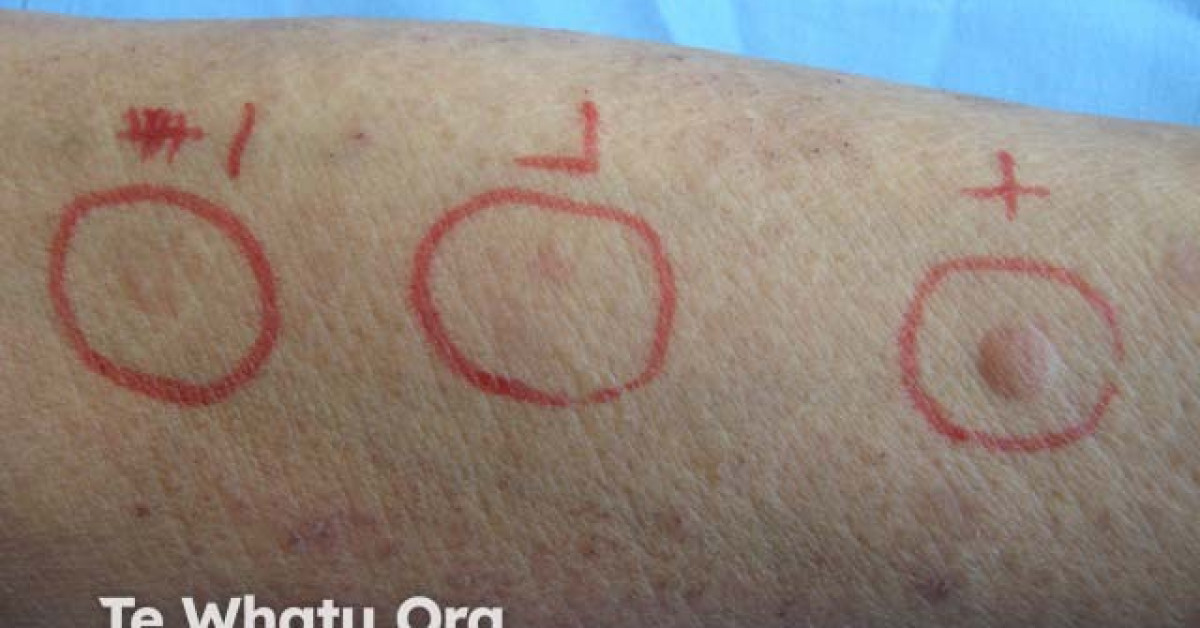 Contact urticaria image