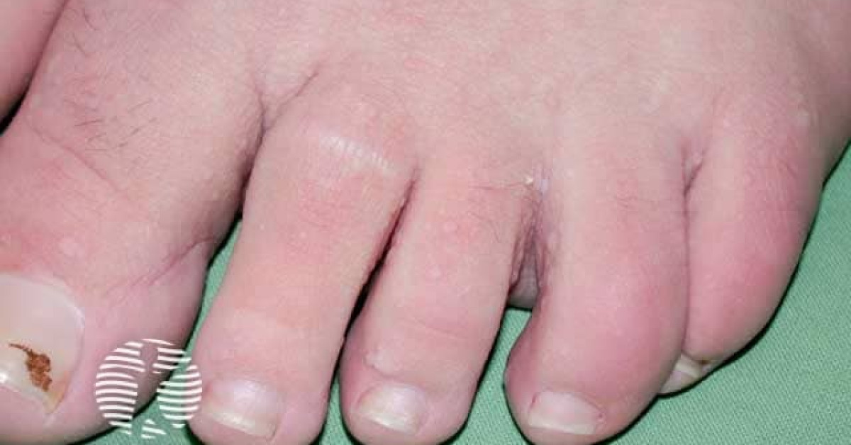 Cowden syndrome image