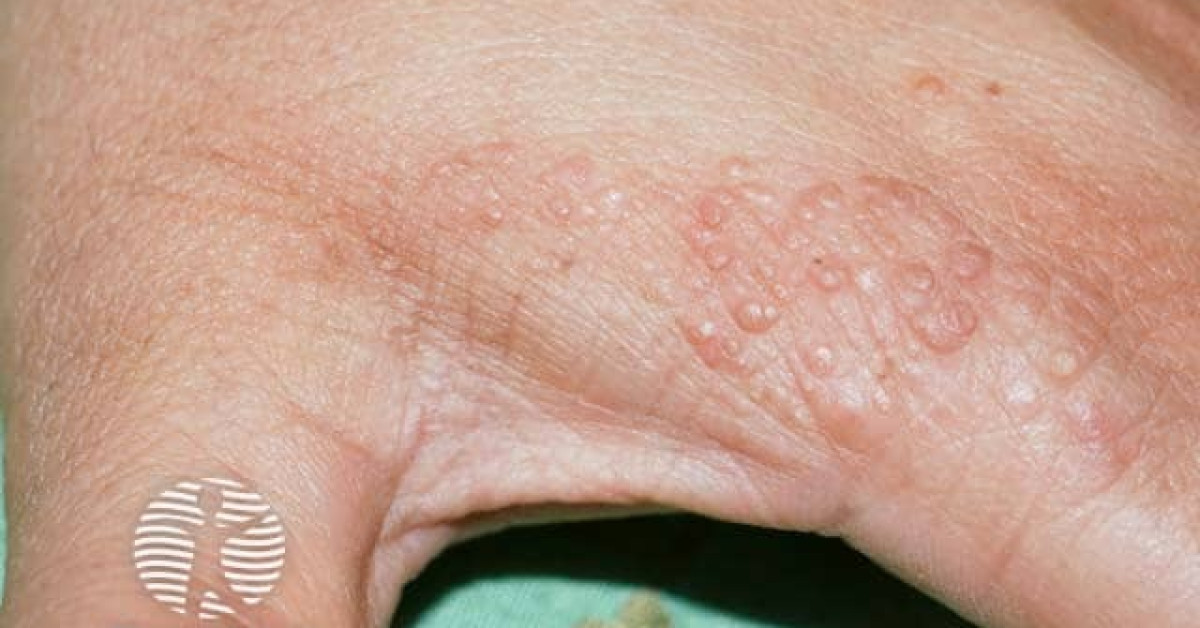 Cowden syndrome image