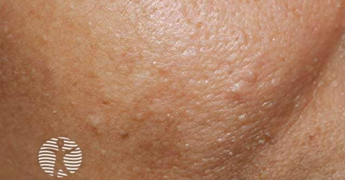 Cowden syndrome image