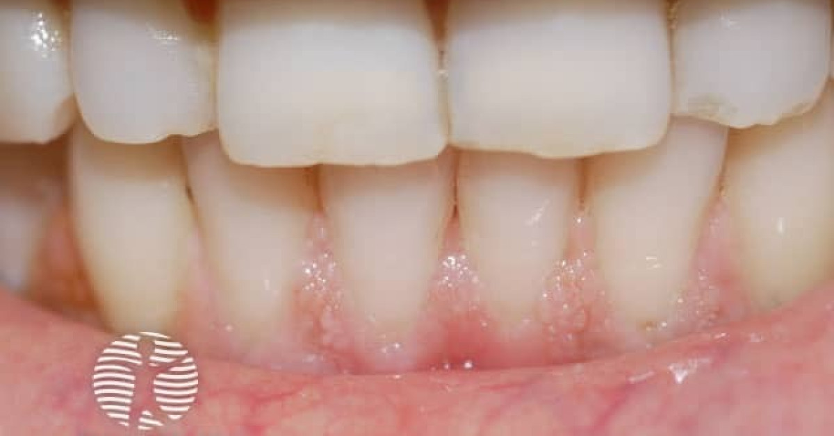 Cowden syndrome image