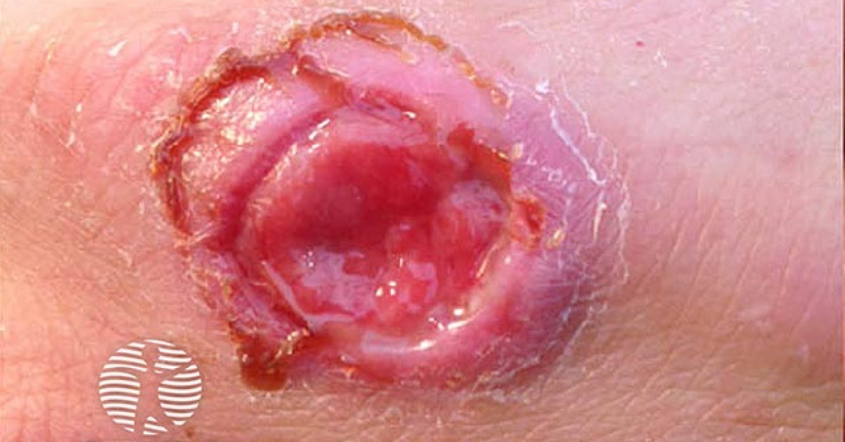 Cowpox image