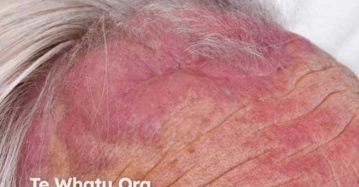 Cutaneous B-cell lymphoma image