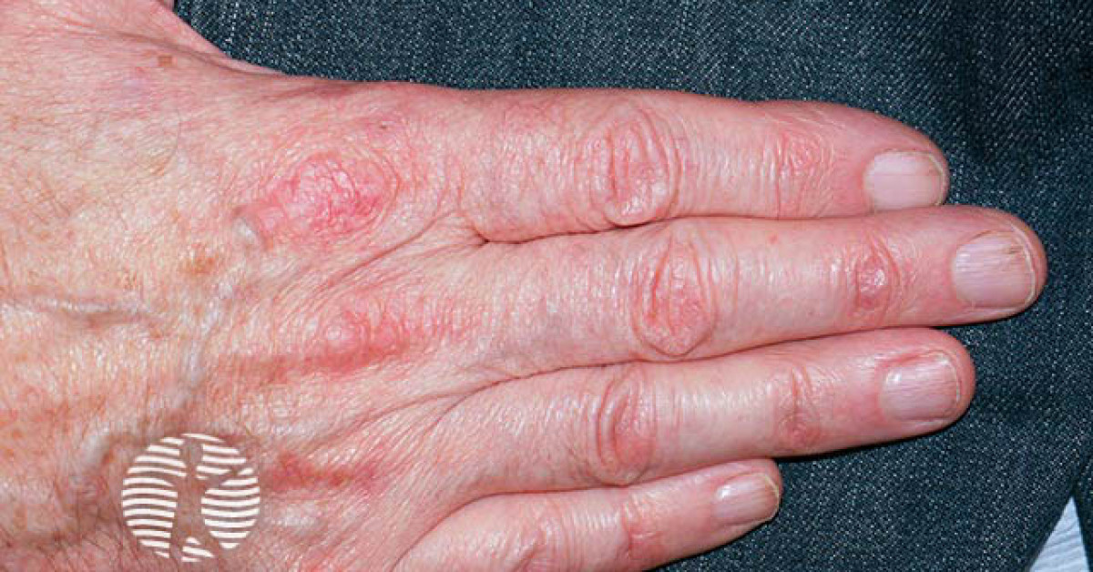 Cutaneous adverse drug reaction image