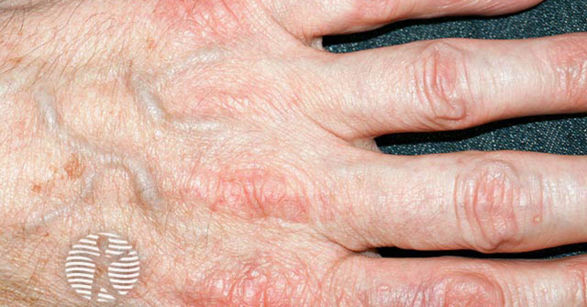 Cutaneous adverse drug reaction image