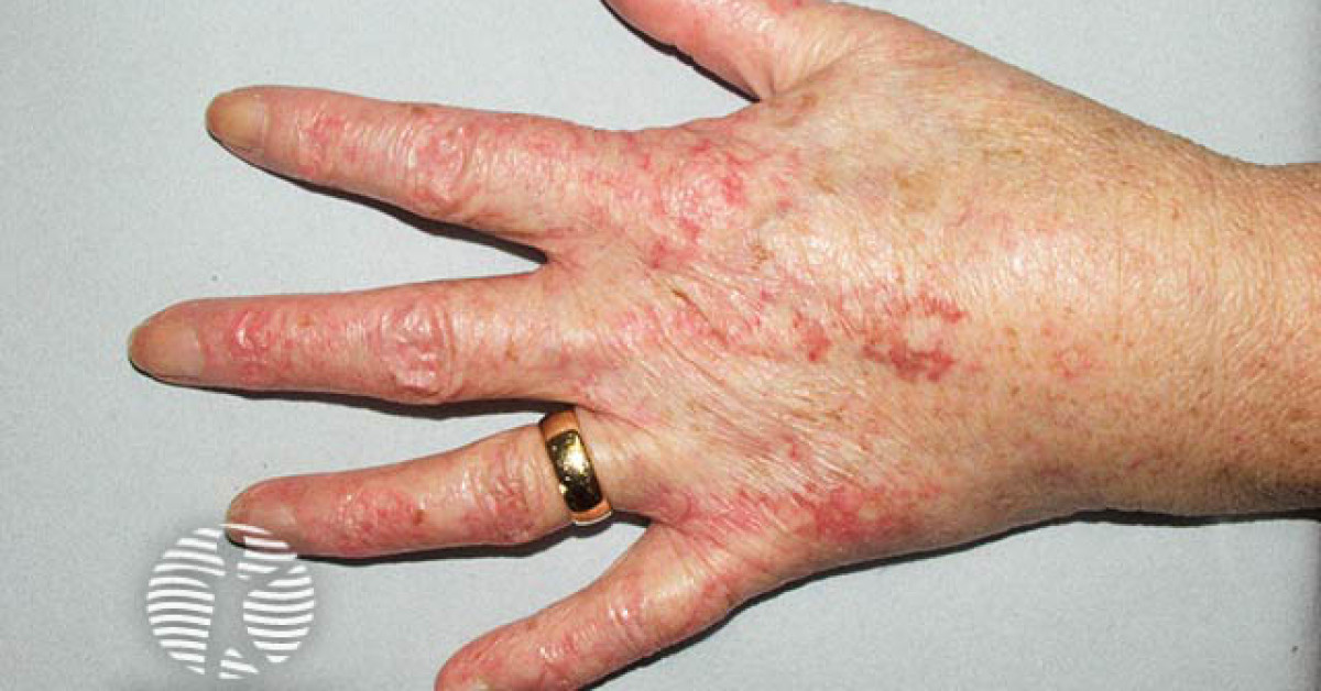 Cutaneous adverse drug reaction image