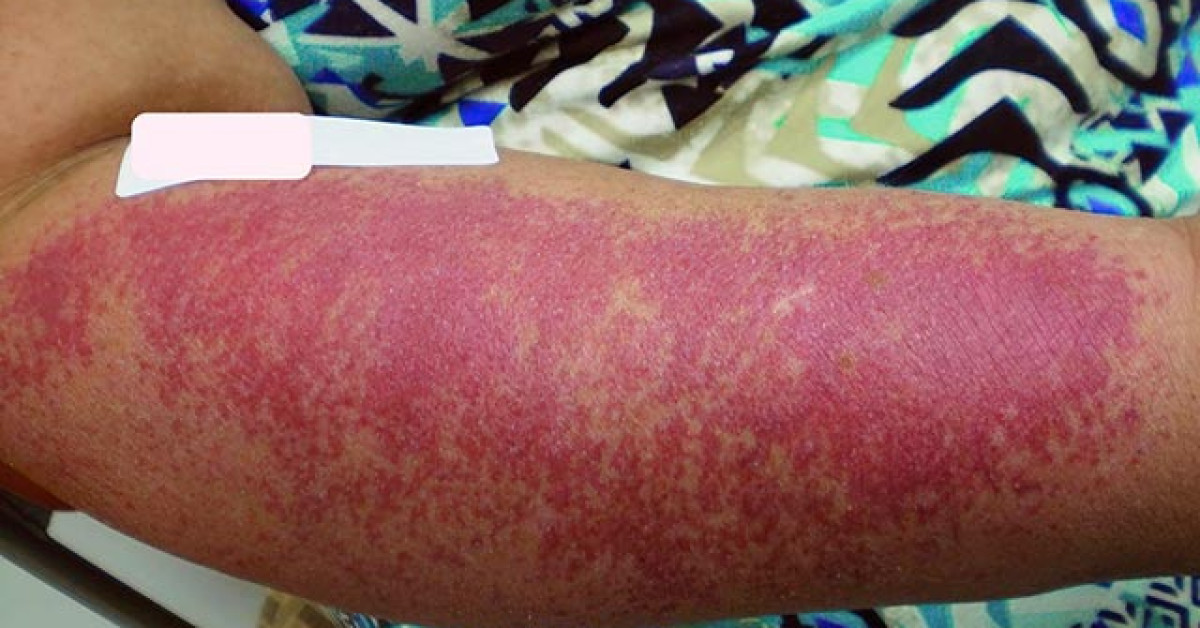 Cutaneous collagenous vasculopathy image