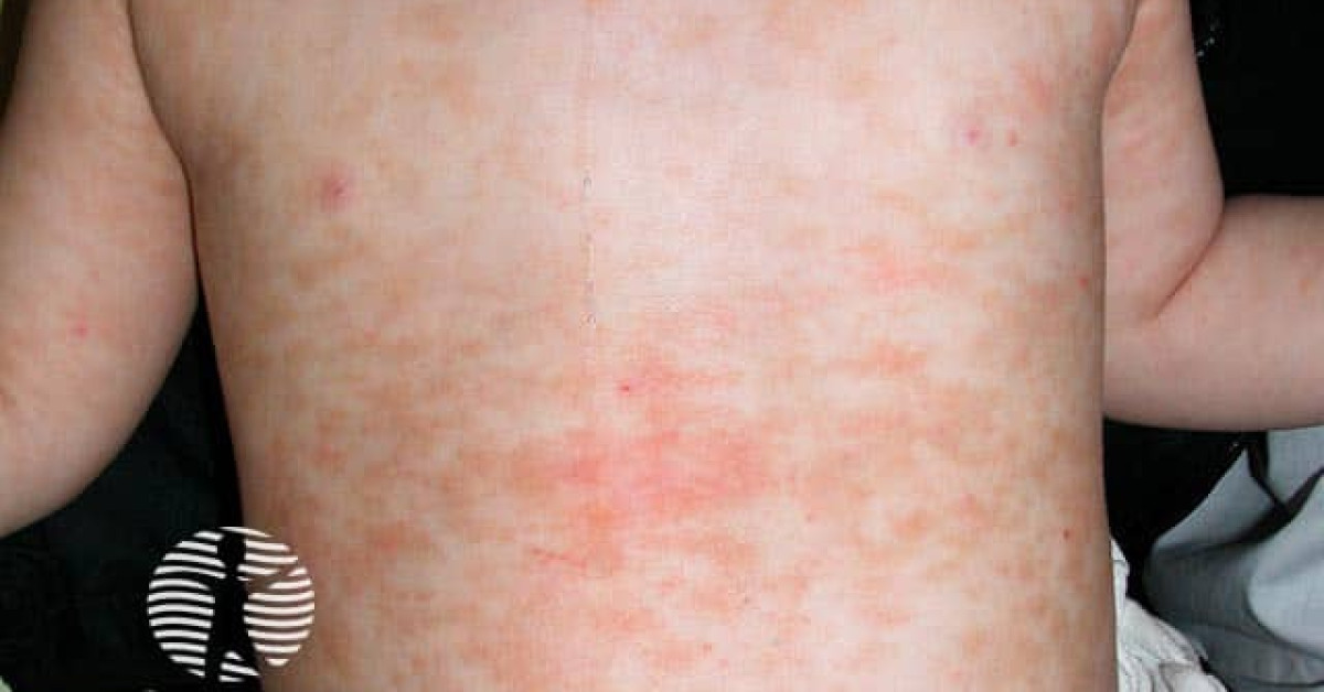 Cutaneous mastocytosis image