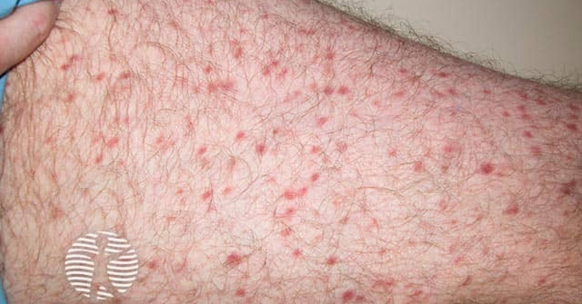 Cutaneous mastocytosis image
