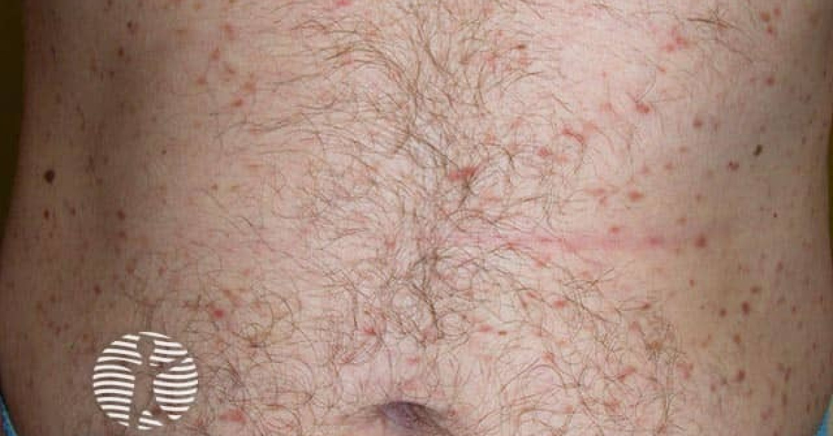 Cutaneous mastocytosis image