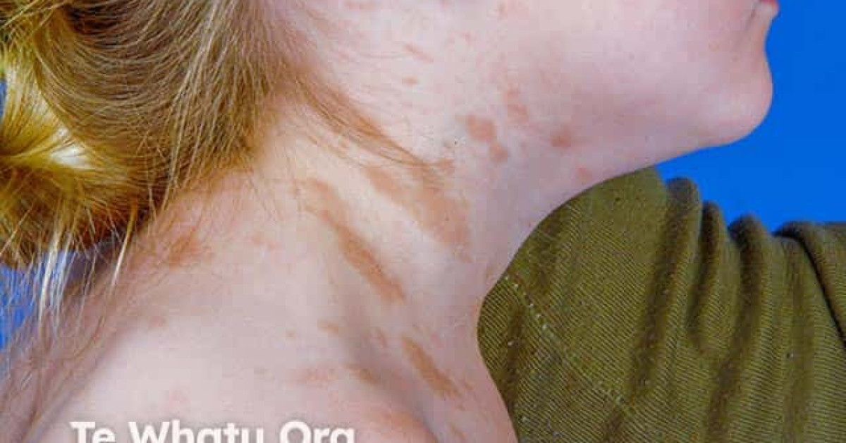 Cutaneous mastocytosis image