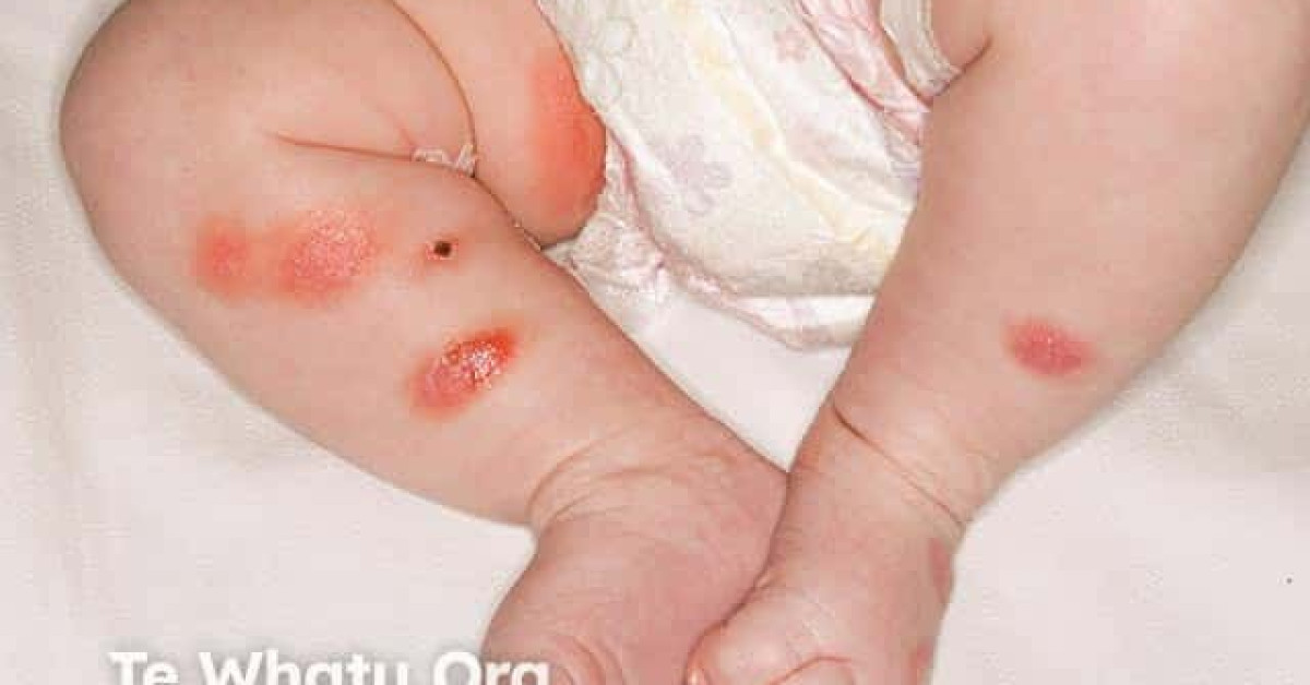 Cutaneous mastocytosis image