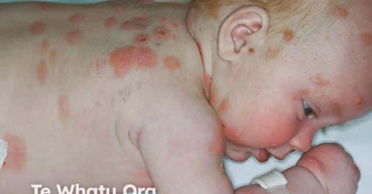 Cutaneous mastocytosis image