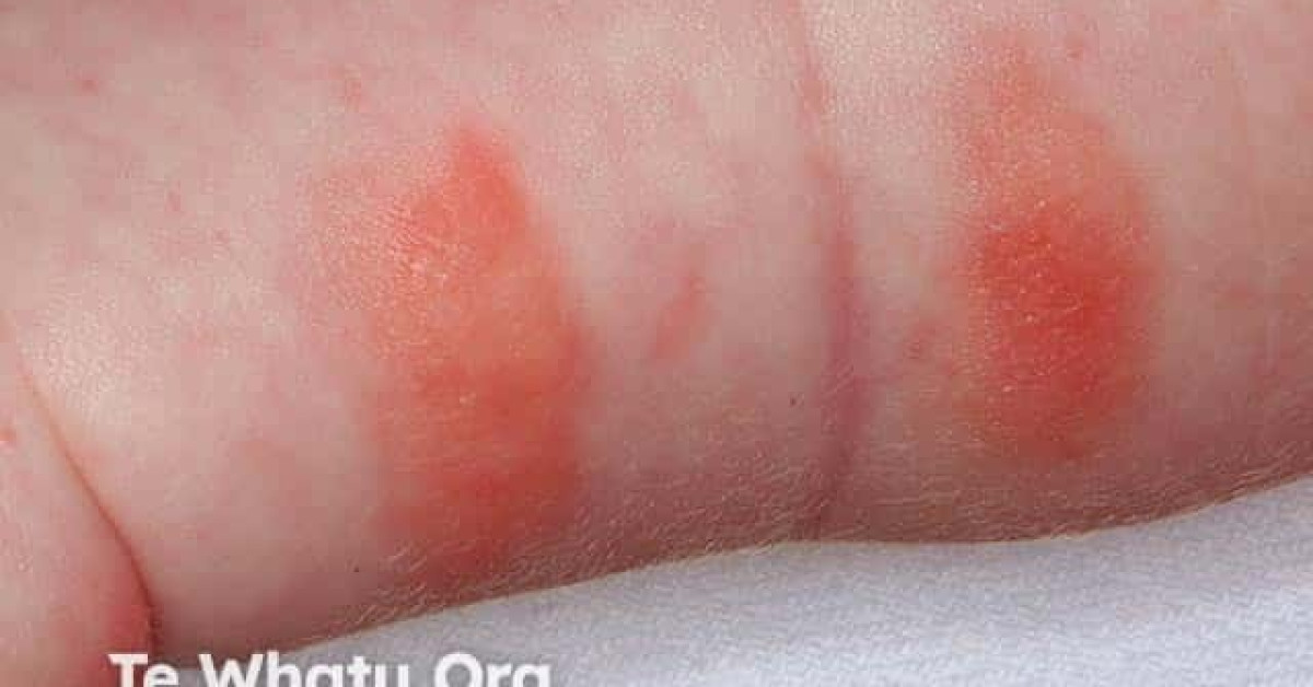 Cutaneous mastocytosis image