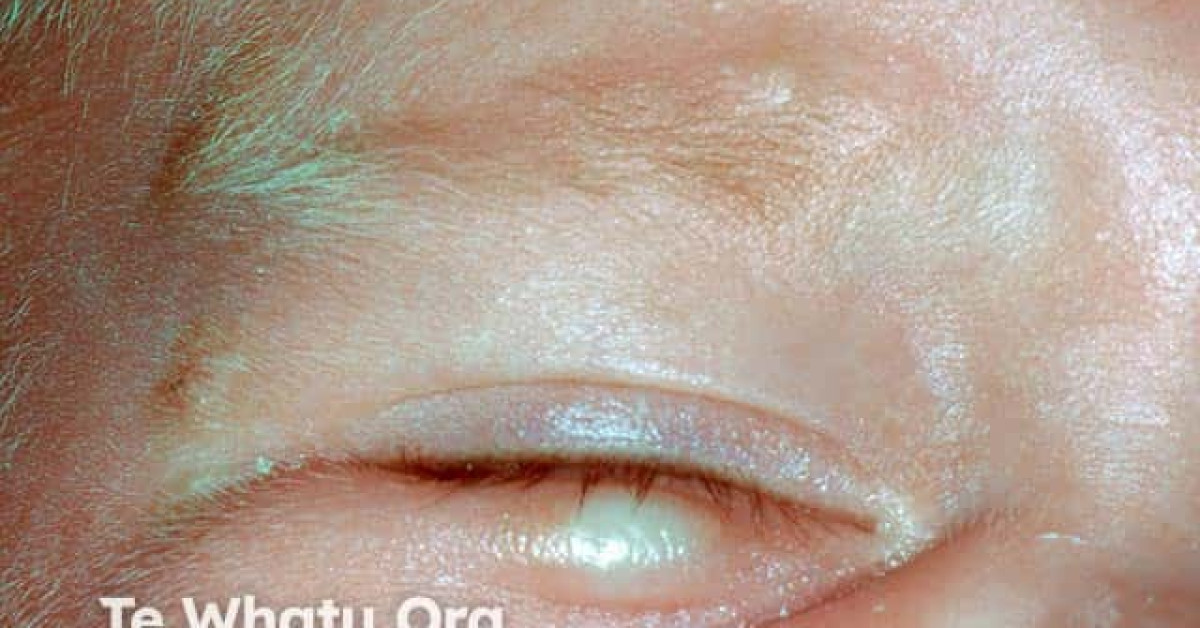 Cutaneous mastocytosis image