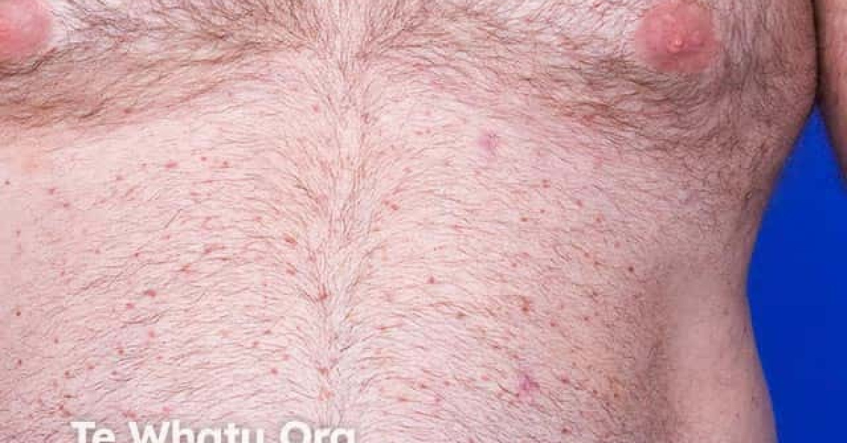 Cutaneous mastocytosis image