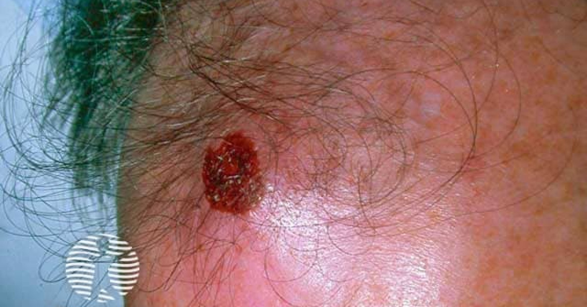 Cytomegalovirus image