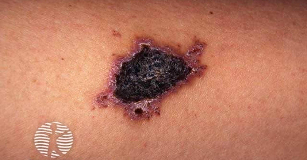 Cytomegalovirus image