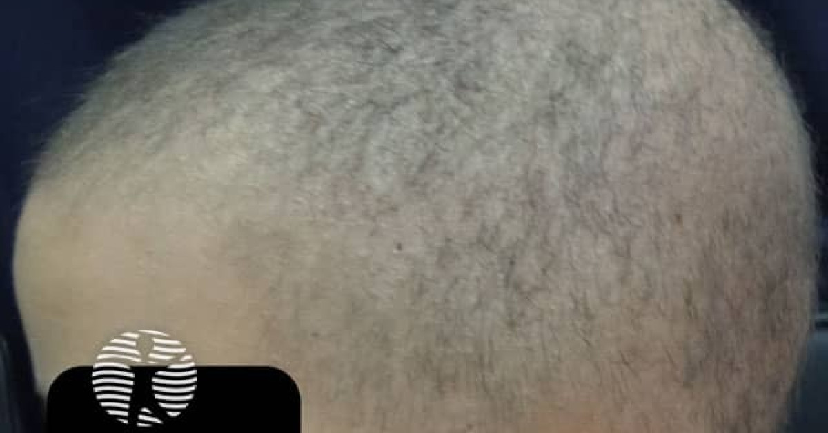 Defects of the hair shaft image