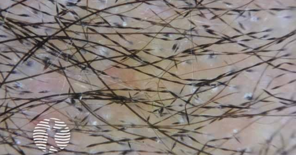 Defects of the hair shaft image