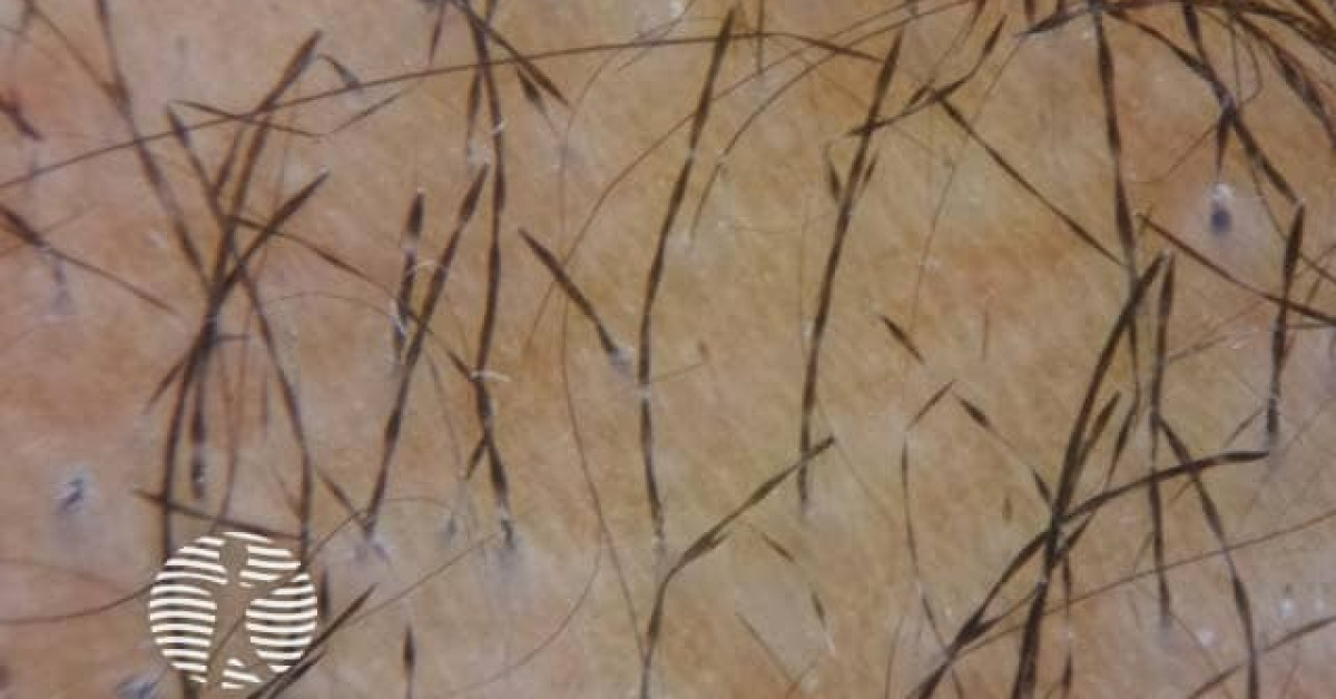 Defects of the hair shaft image