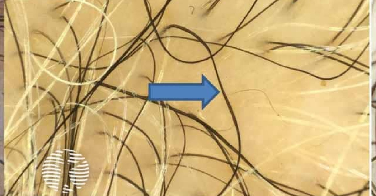 Defects of the hair shaft image