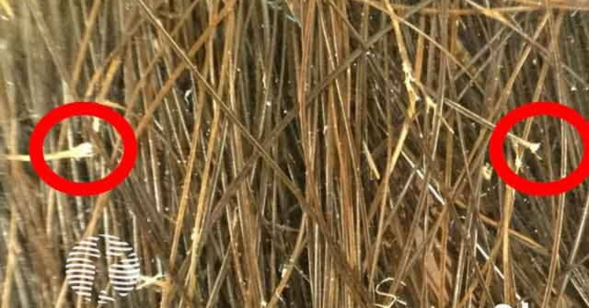 Defects of the hair shaft image