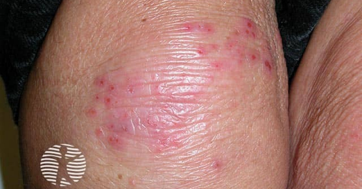 Dermatitis herpetiformis image