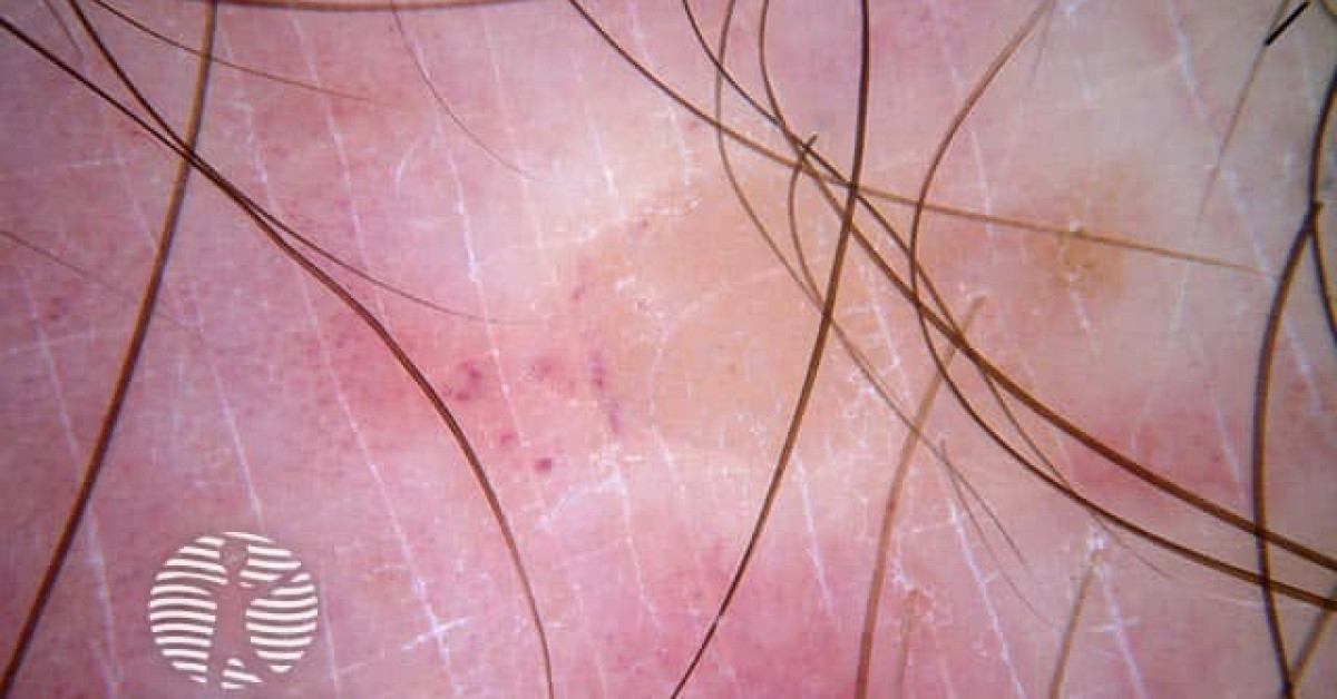 Dermatitis herpetiformis image