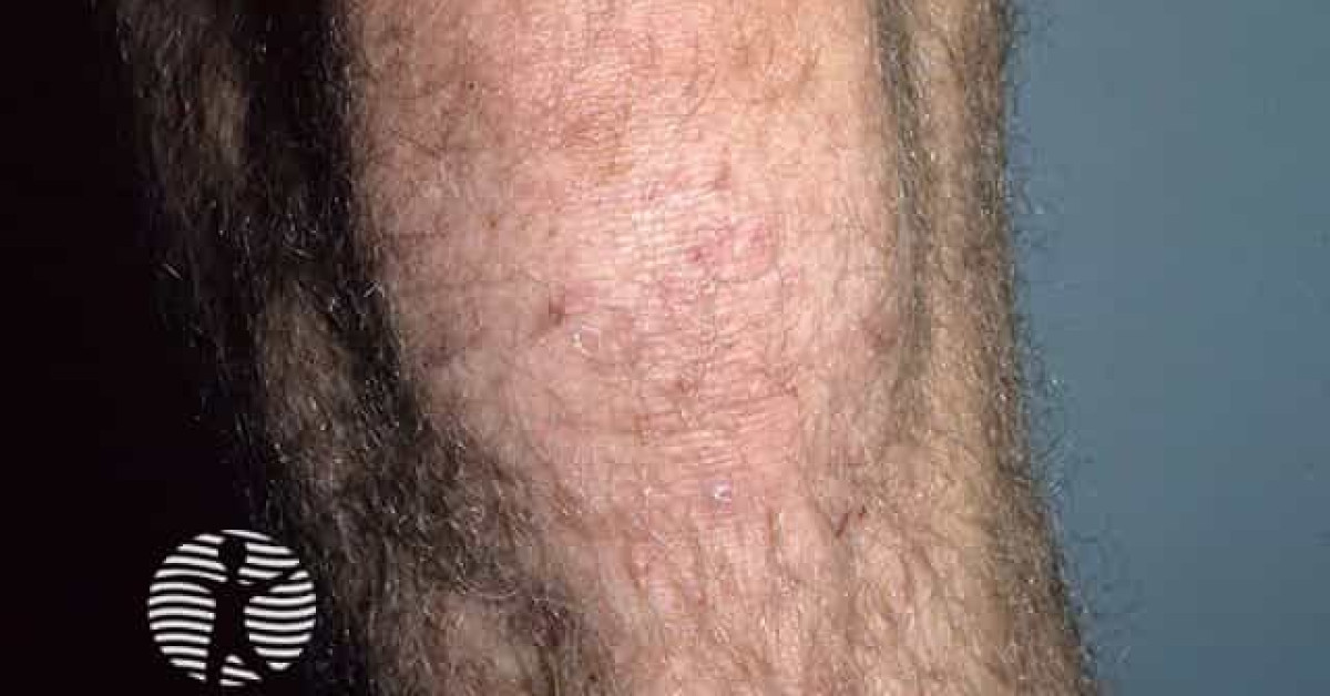 Dermatitis herpetiformis image