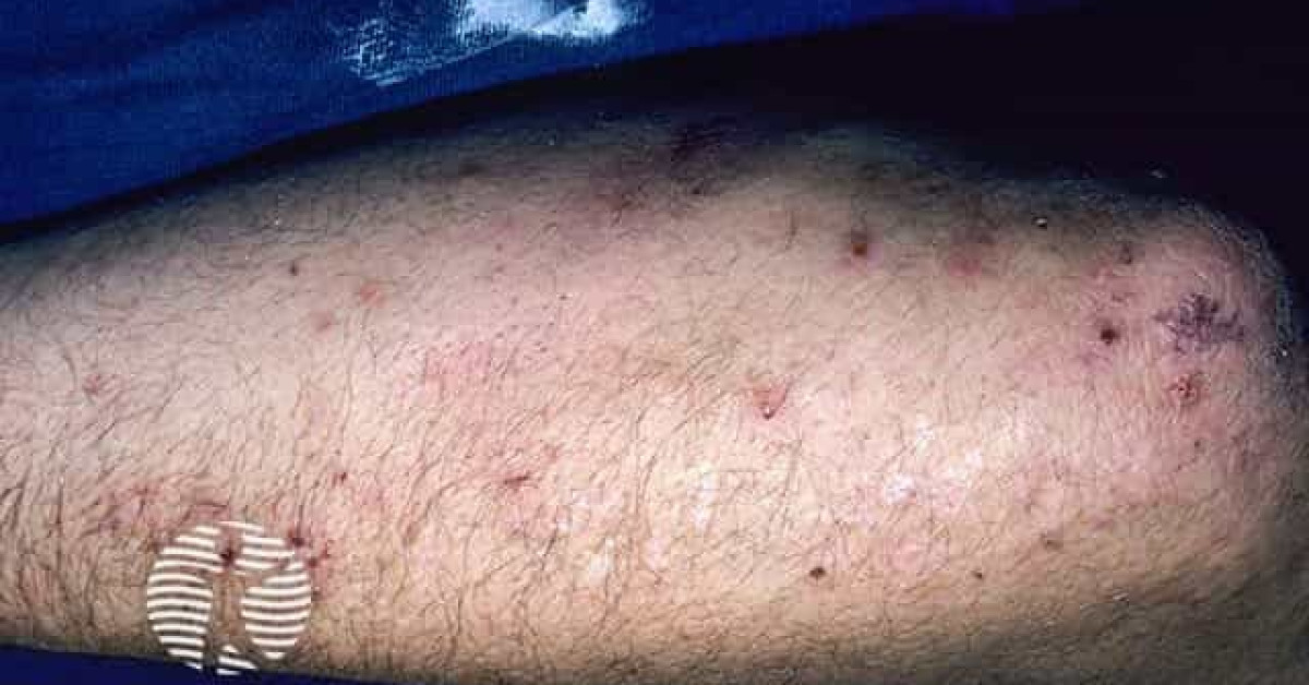 Dermatitis herpetiformis image