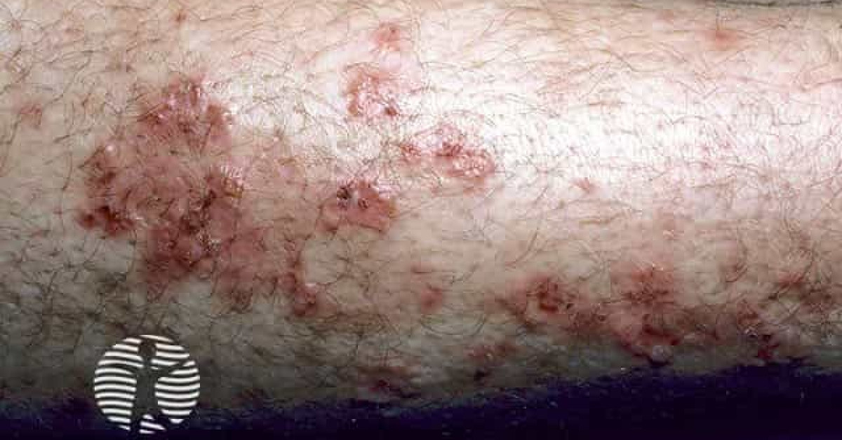 Dermatitis herpetiformis image