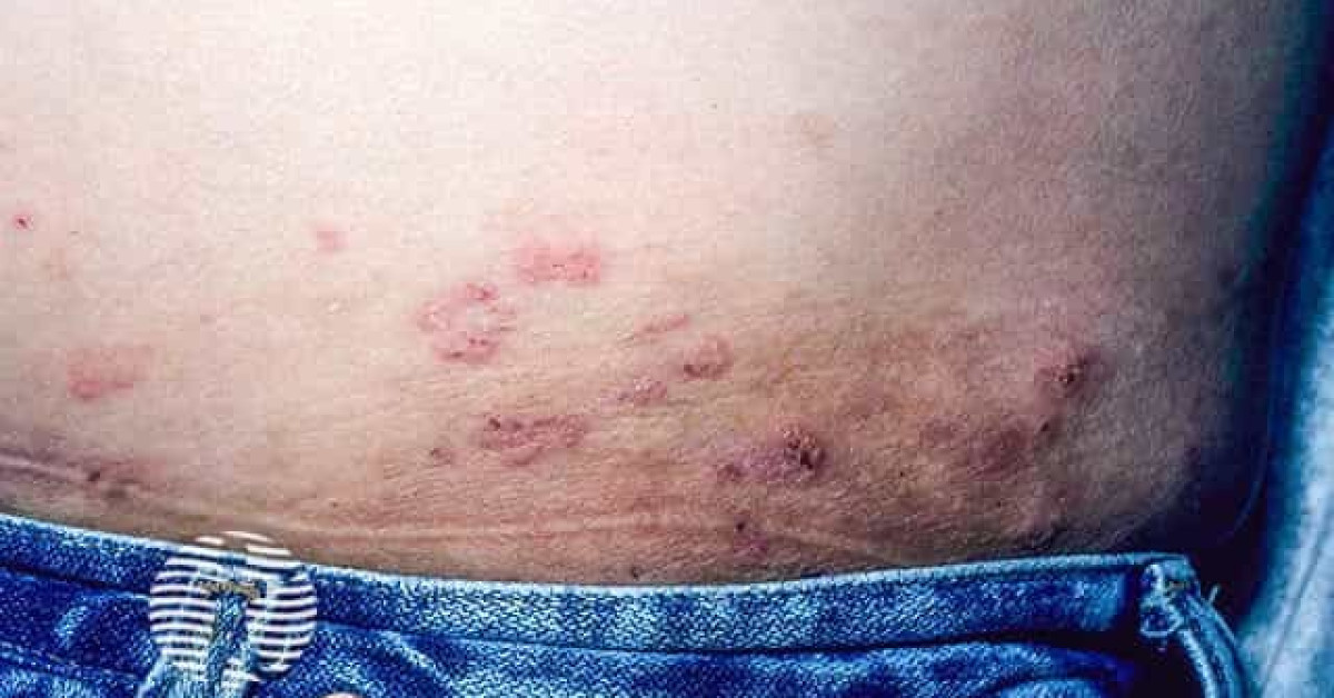 Dermatitis herpetiformis image