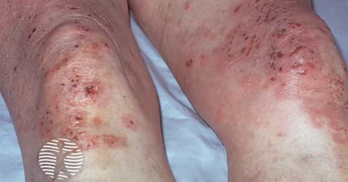 Dermatitis Herpetiformis Dermatitis Herpetiformis Presenting As