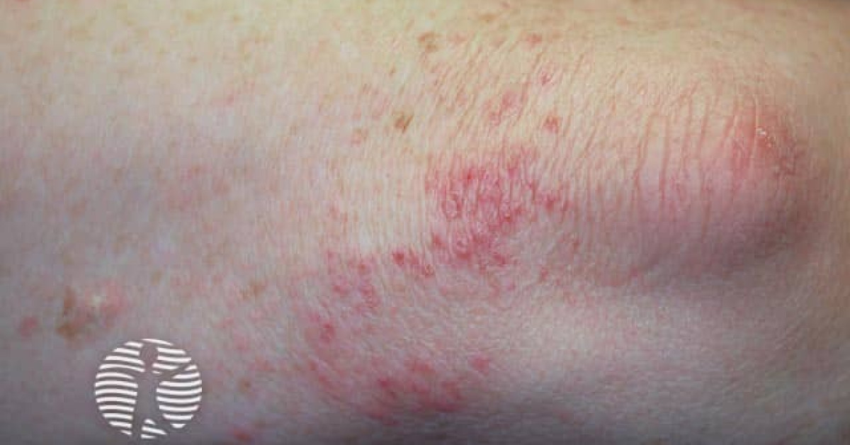Dermatitis herpetiformis image